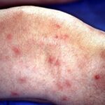 Alpha-1 and Panniculitis